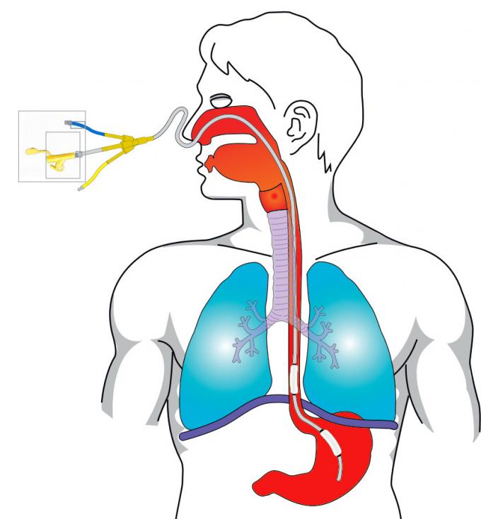 One Balloon Enteral Feeding Tube For Esophageal Pressure Measurement ...